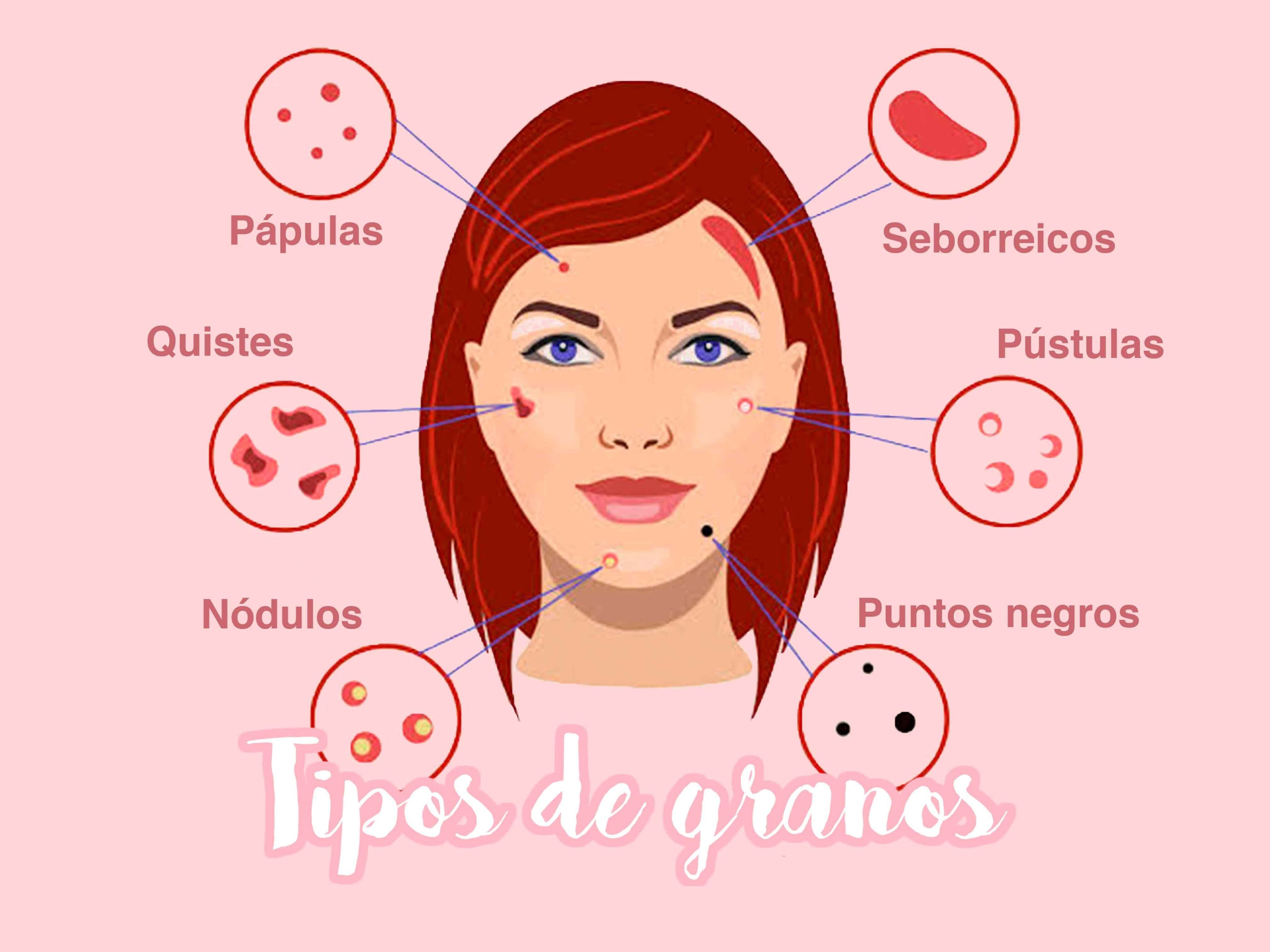 Tipos de espinillas y como reconocerlas - MaJu Studios » Modelos WebCam ...